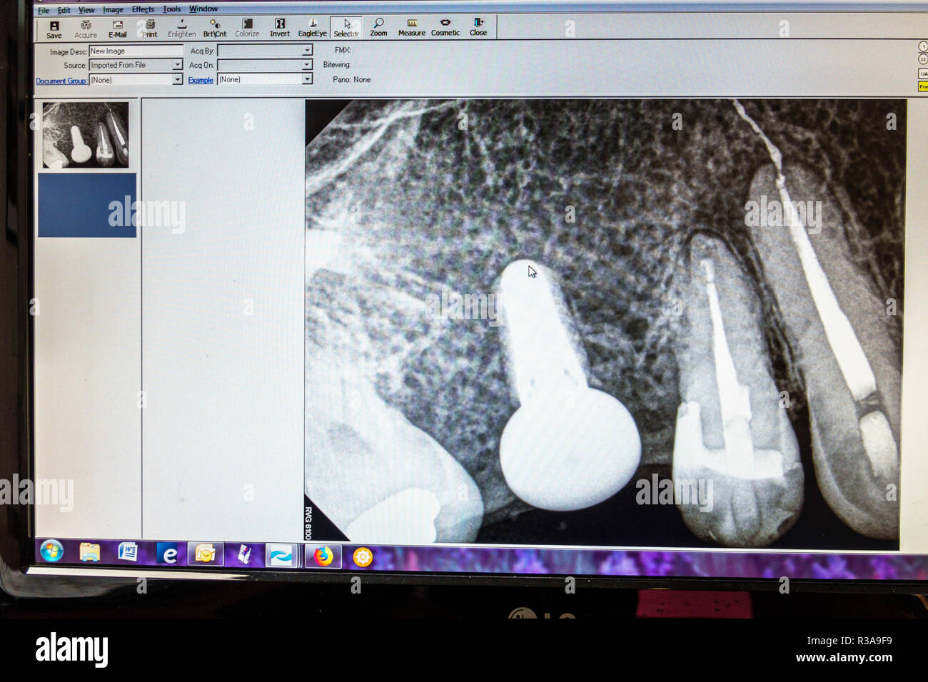 Zähne Xray Stockfotos & Zähne Xray Bilder - Alamy