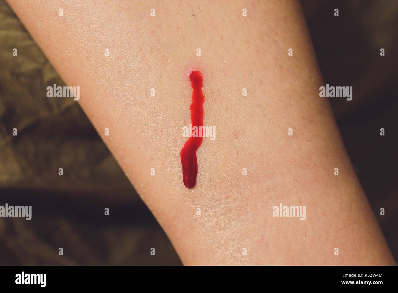 Eine Injektion. Behandlung. Menschliches Blut. Blut Krankheit. Spender ...