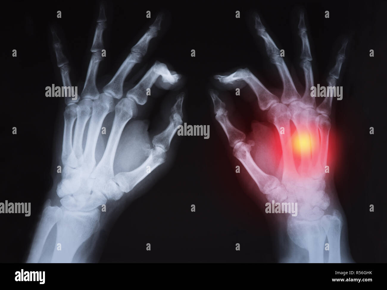 Die menschliche Hand x-ray rot markiert Stockfotografie - Alamy