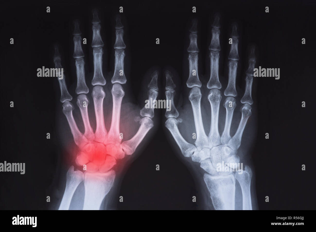 Arthritis hands xray -Fotos und -Bildmaterial in hoher Auflösung – Alamy