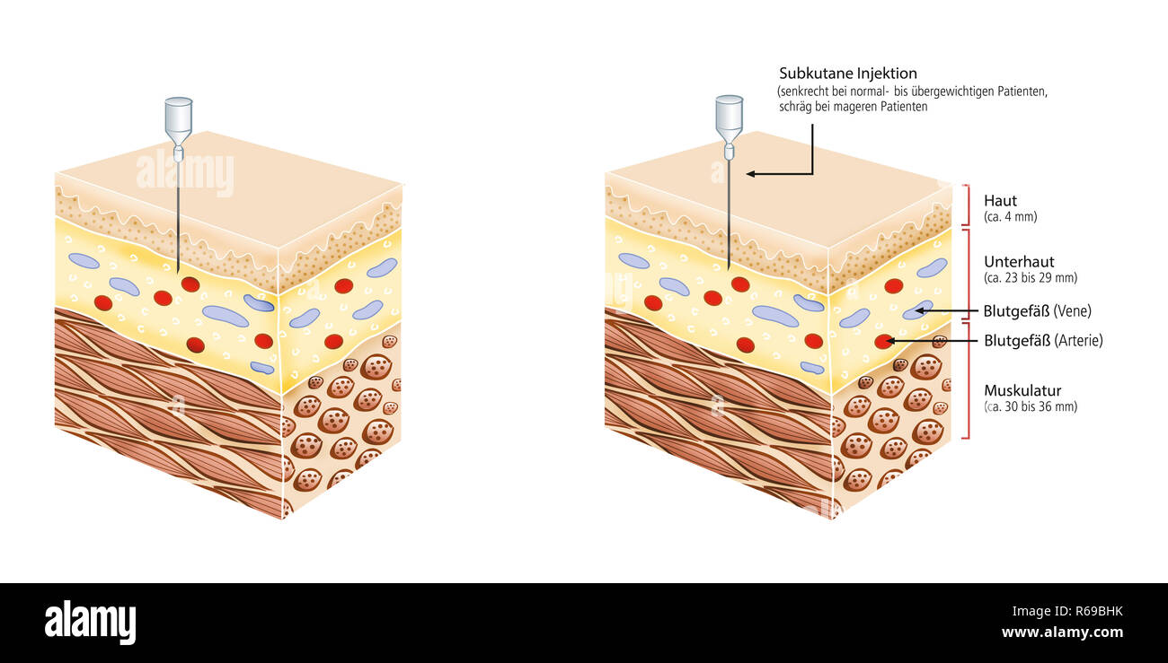 Subkutane injektion -Fotos und -Bildmaterial in hoher Auflösung – Alamy