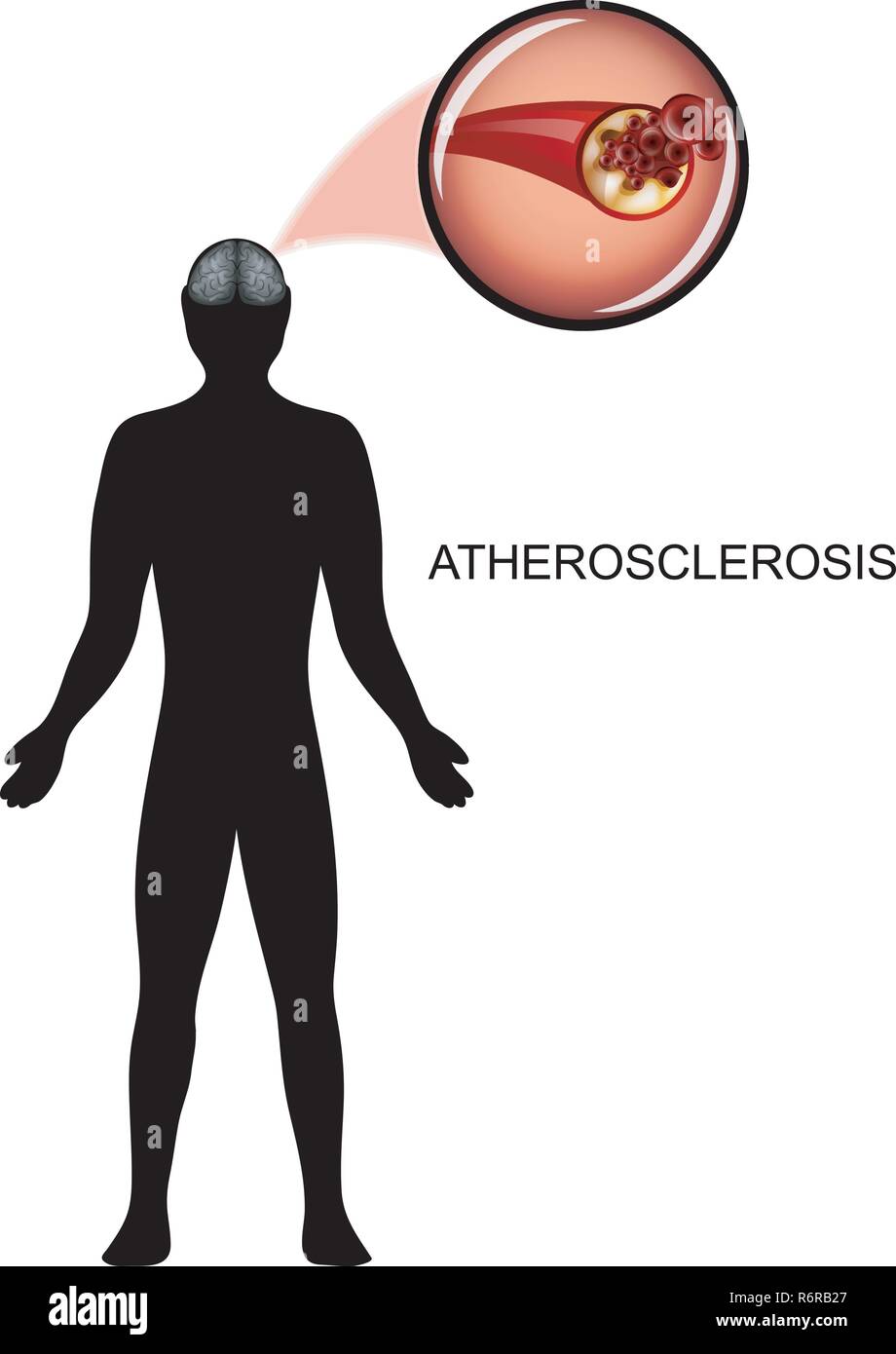 Medizinische Vector Illustration der Verstopfung der Blutgefäße des ...