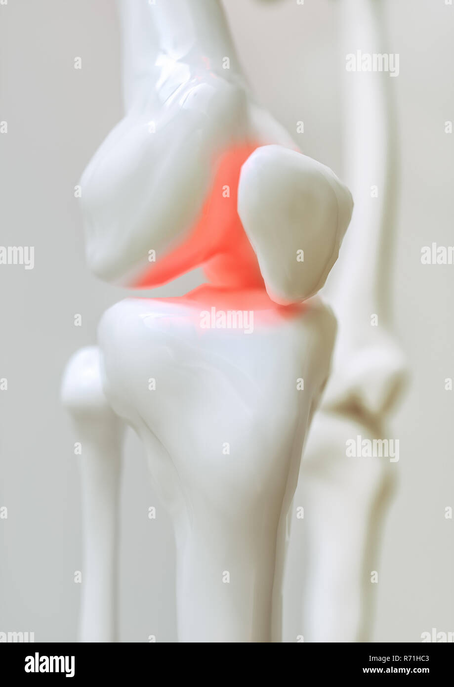 Knie prothese -Fotos und -Bildmaterial in hoher Auflösung – Alamy