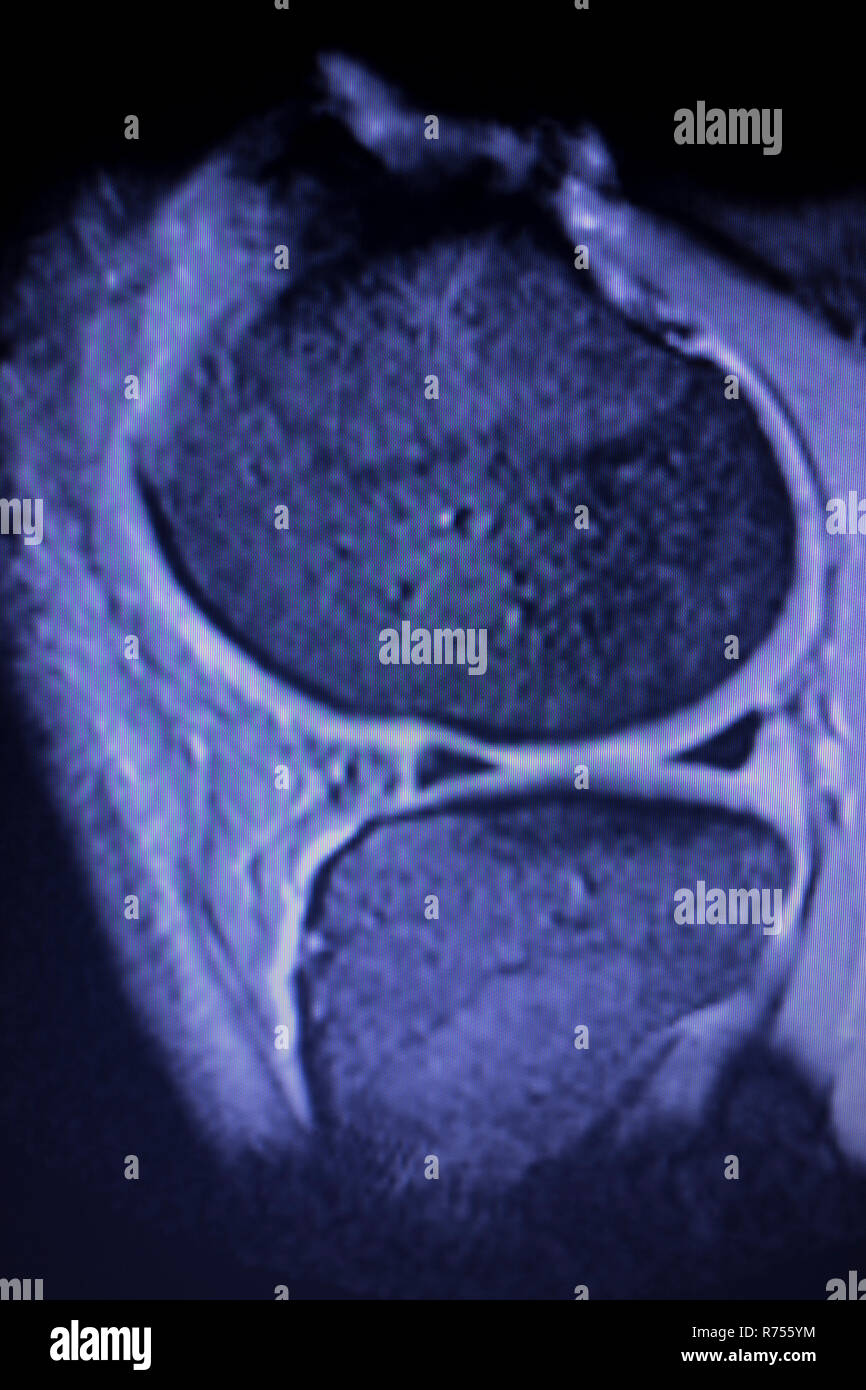 Die Magnetresonanztomographie MRT Knie posterioren Horn medialen ...