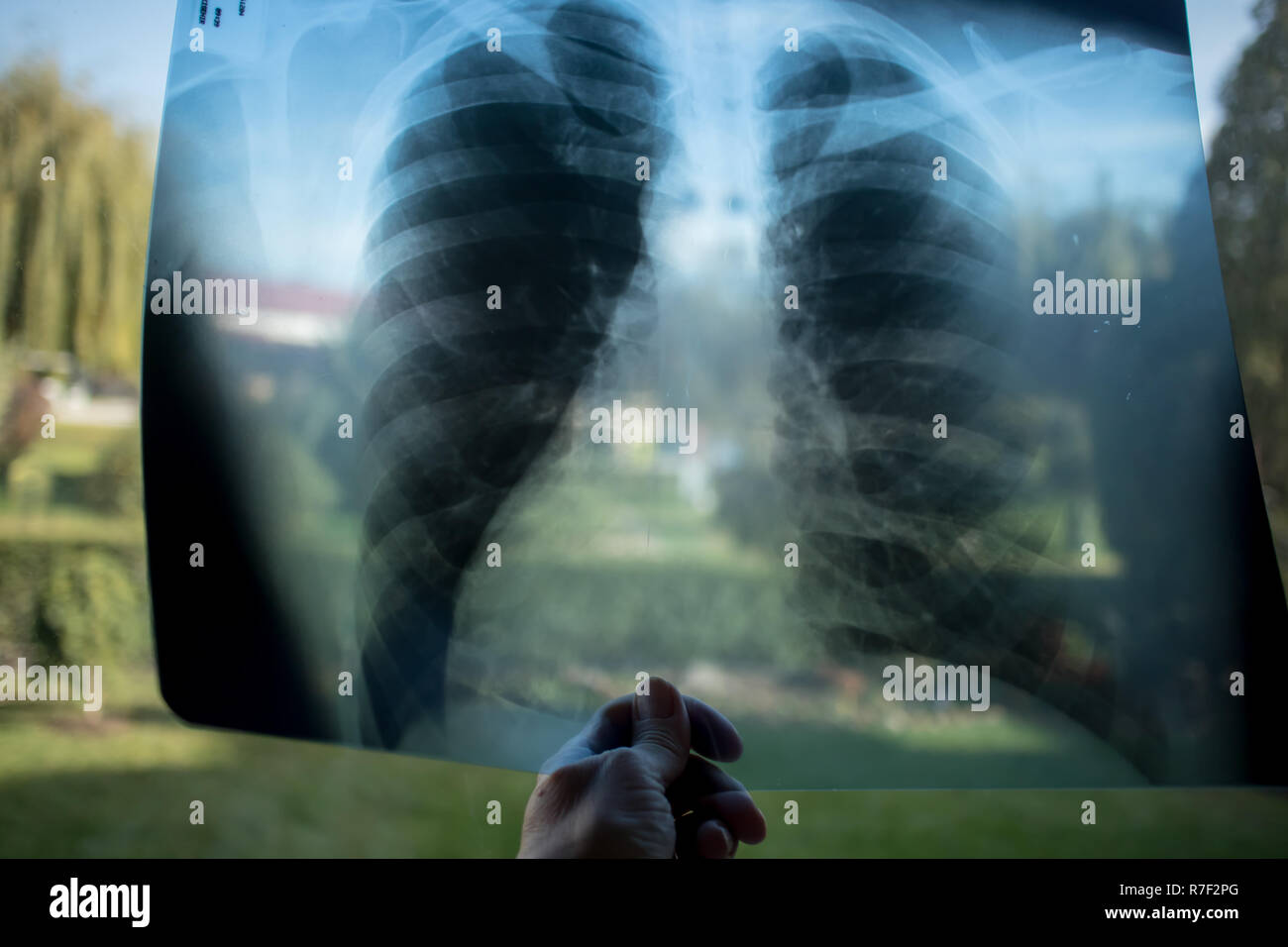 Bronchitis radiography -Fotos und -Bildmaterial in hoher Auflösung – Alamy
