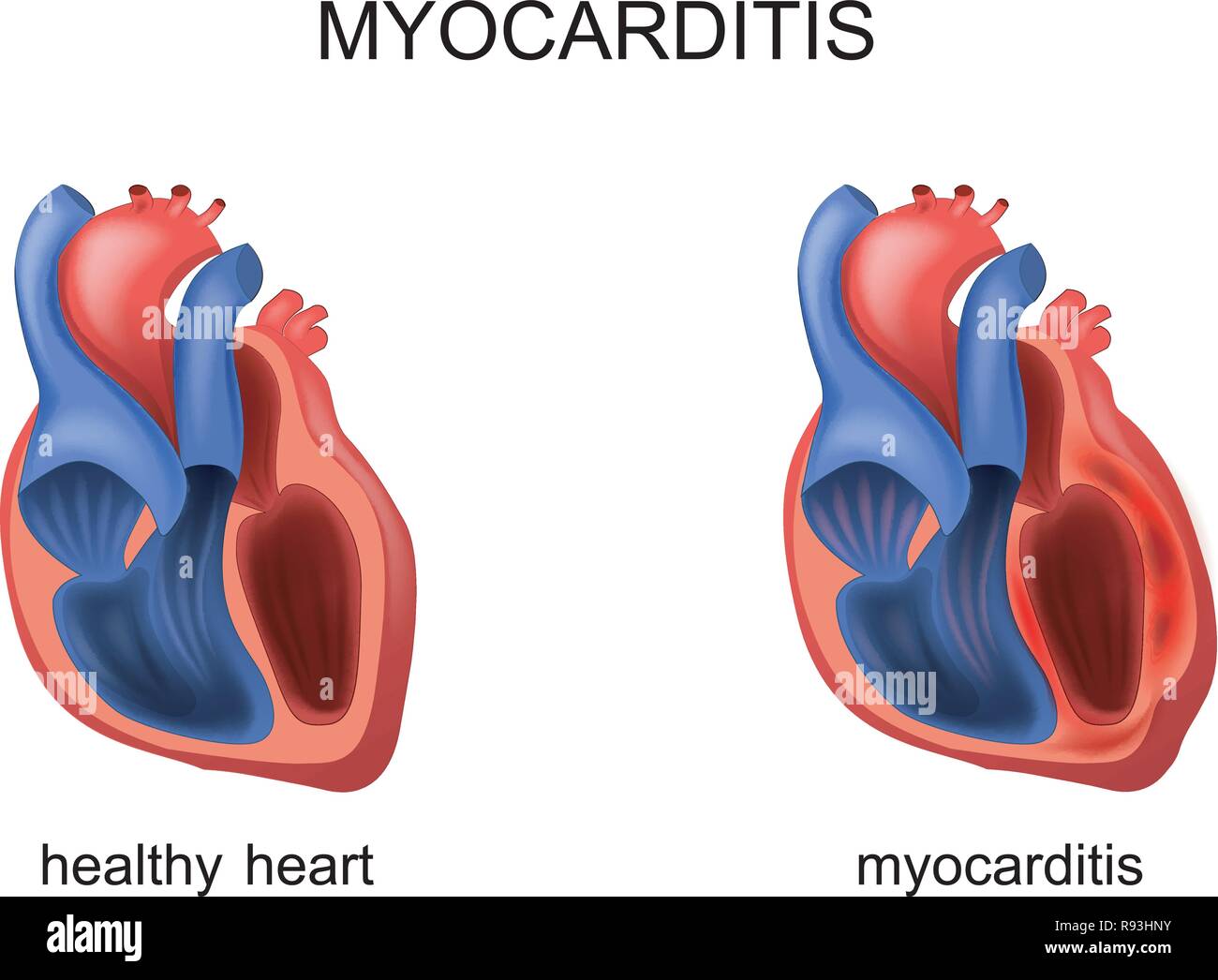 Krankes organ -Fotos und -Bildmaterial in hoher Auflösung – Alamy