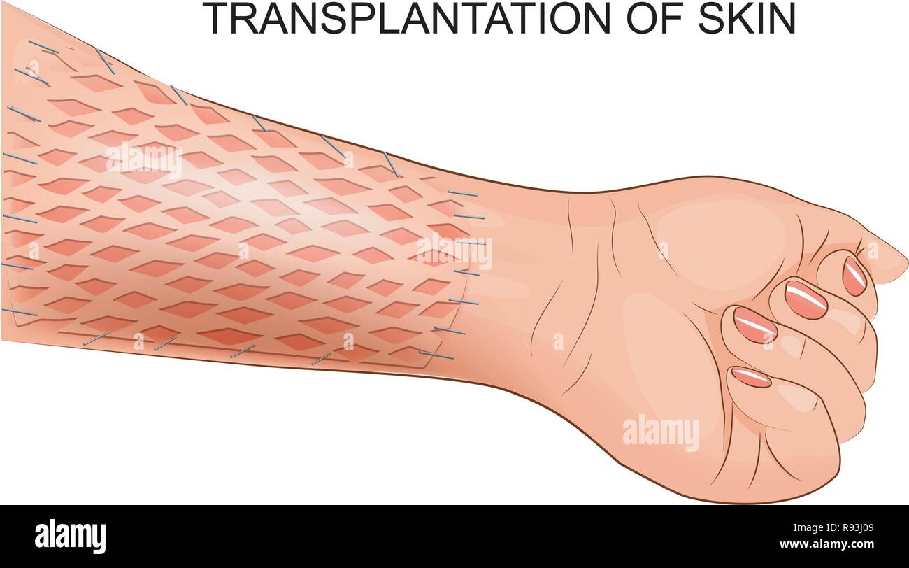 Skin graft -Fotos und -Bildmaterial in hoher Auflösung – Alamy