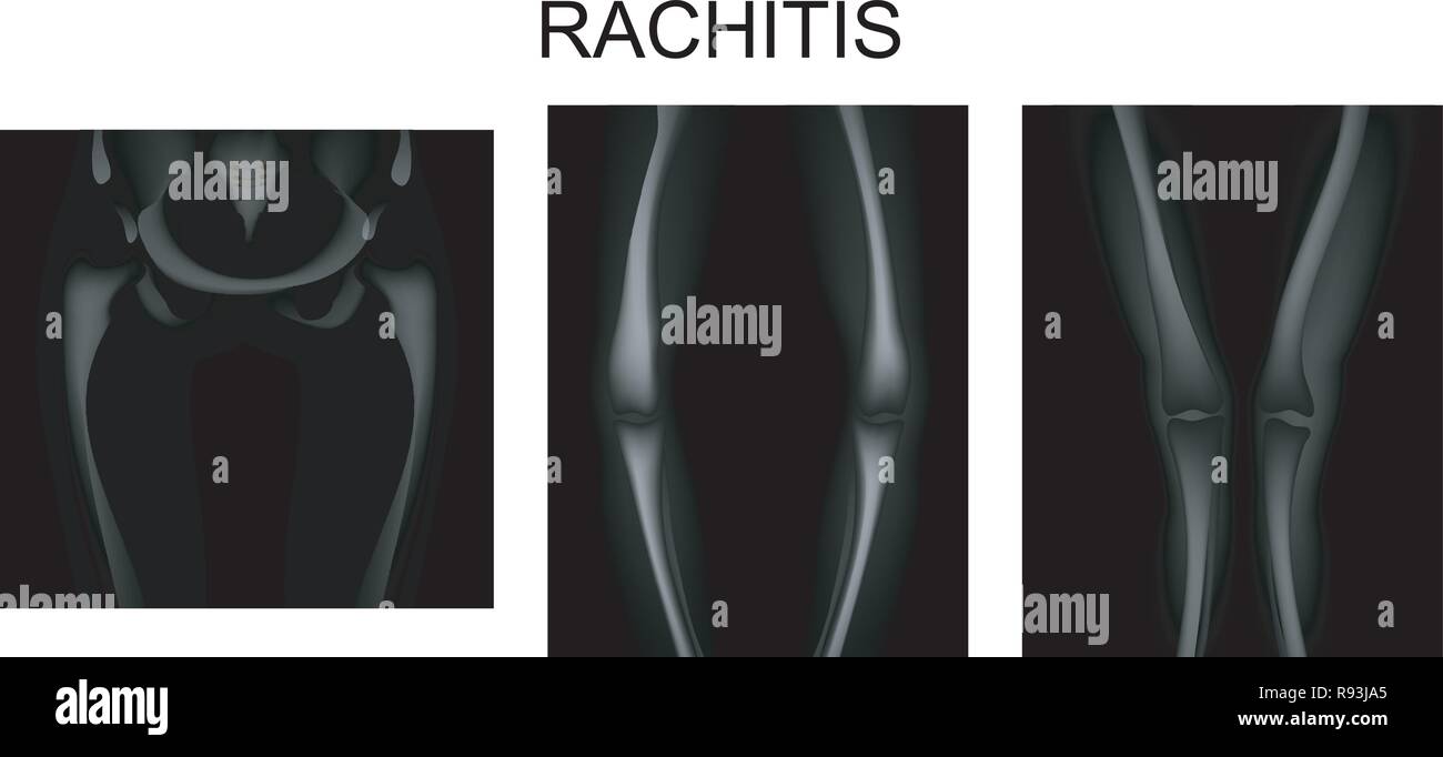 Arthritis im kreuzbein -Fotos und -Bildmaterial in hoher Auflösung – Alamy