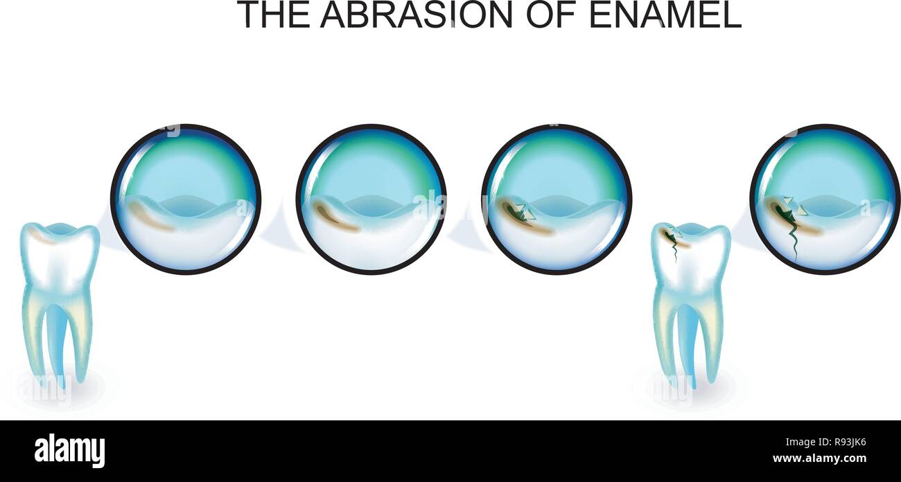 Zahn parodontitis illustration Stock-Vektorgrafiken kaufen - Alamy