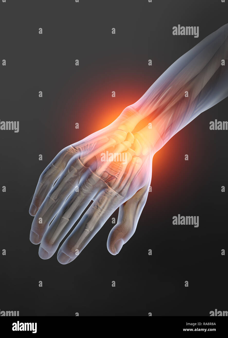 Osteoarthritis am handgelenk -Fotos und -Bildmaterial in hoher ...