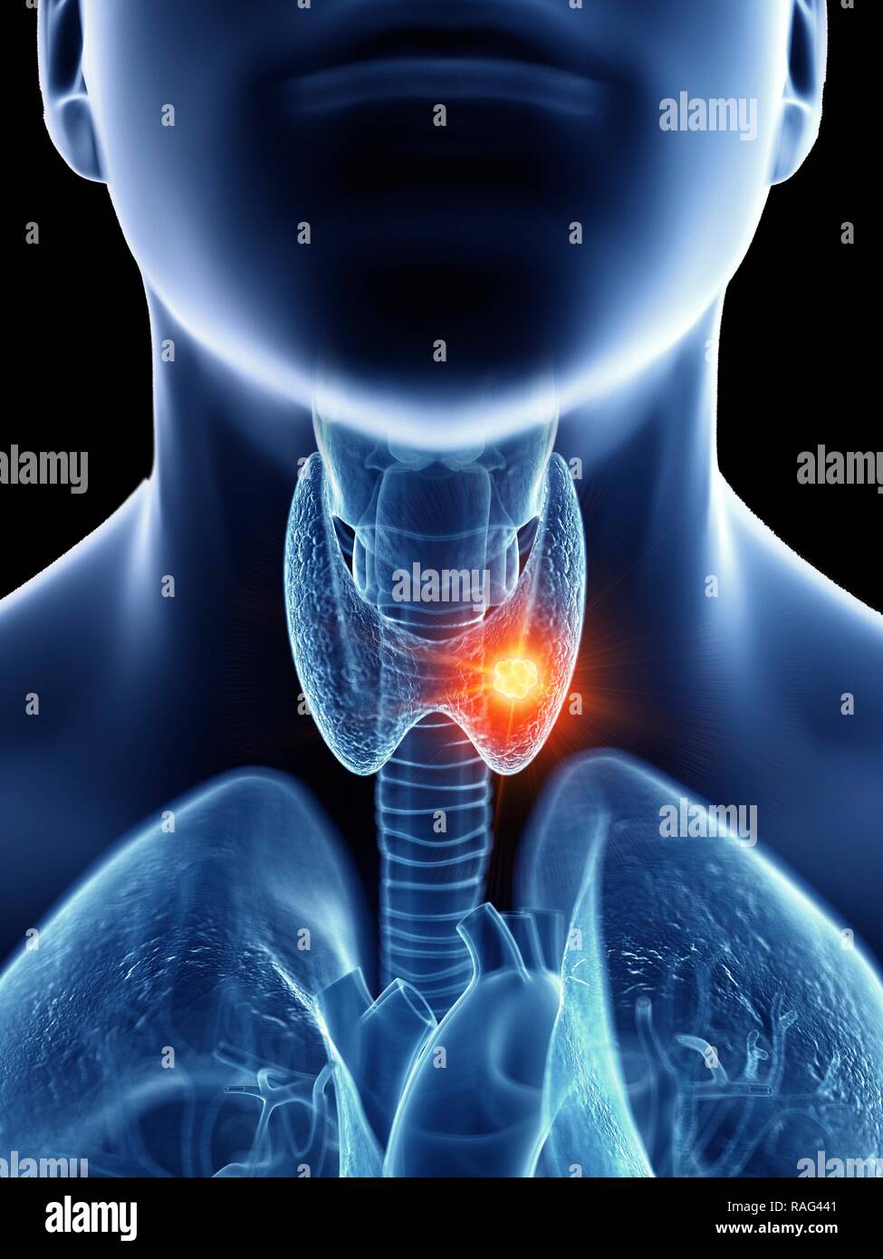Human larynx tumor -Fotos und -Bildmaterial in hoher Auflösung – Alamy