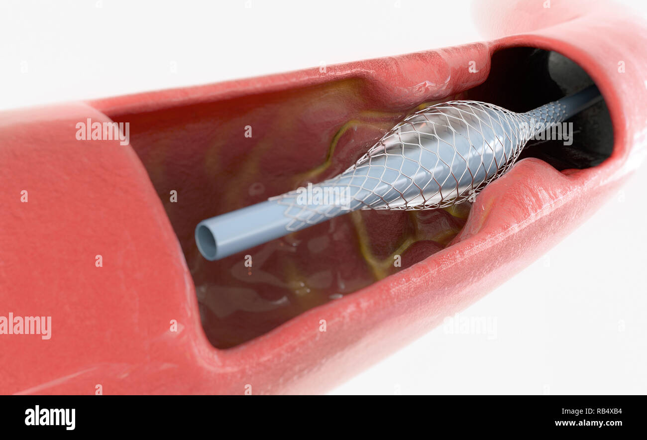 Coronary Stent Stockfotos und -bilder Kaufen - Alamy