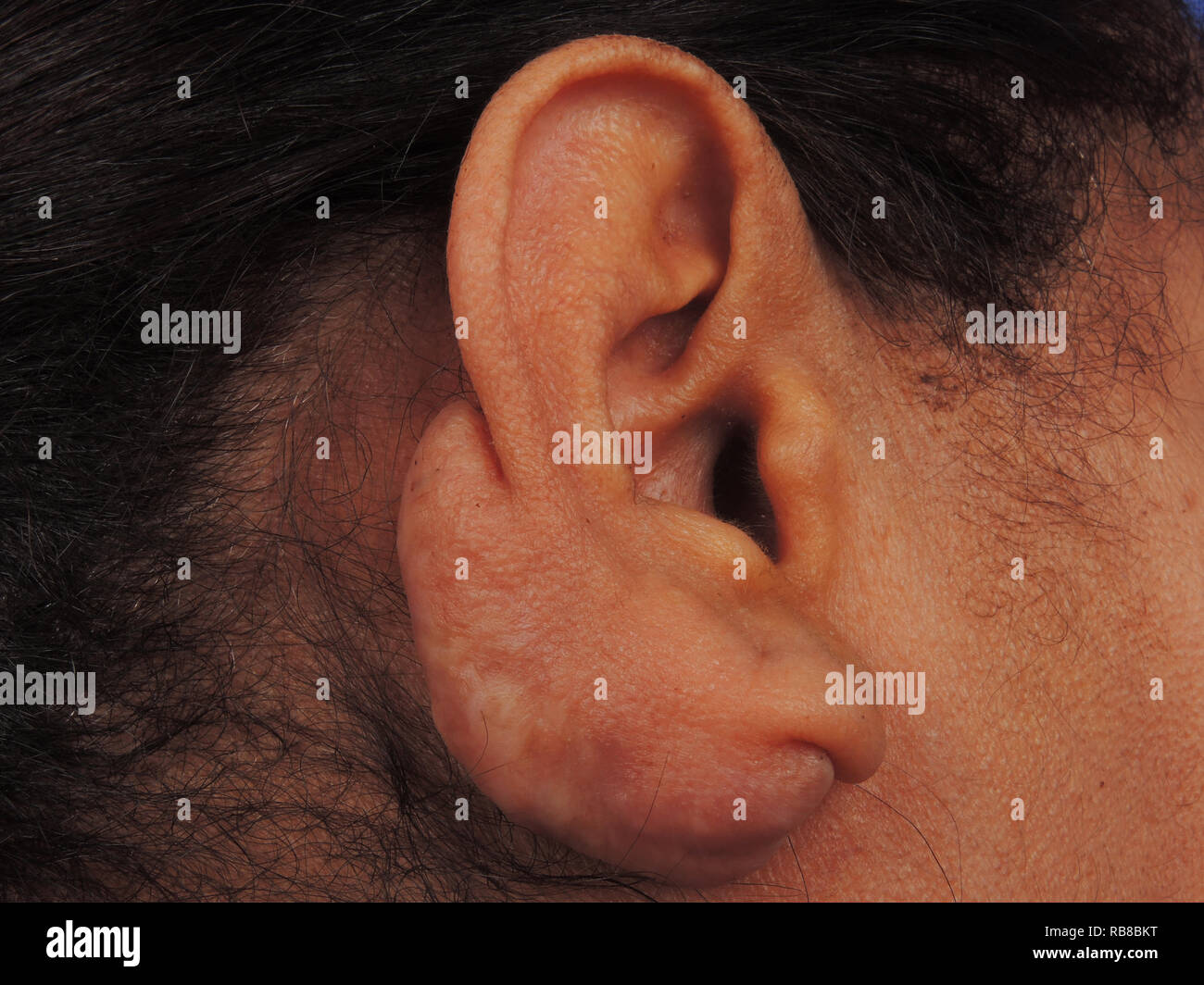 Benign skin tumor -Fotos und -Bildmaterial in hoher Auflösung – Alamy