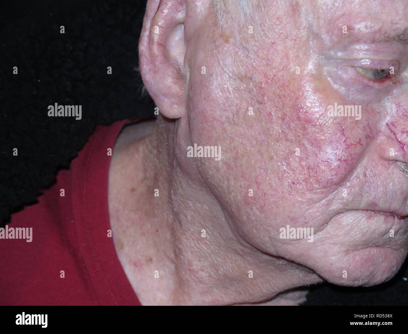 Skin cancer cells -Fotos und -Bildmaterial in hoher Auflösung - Seite 2 ...