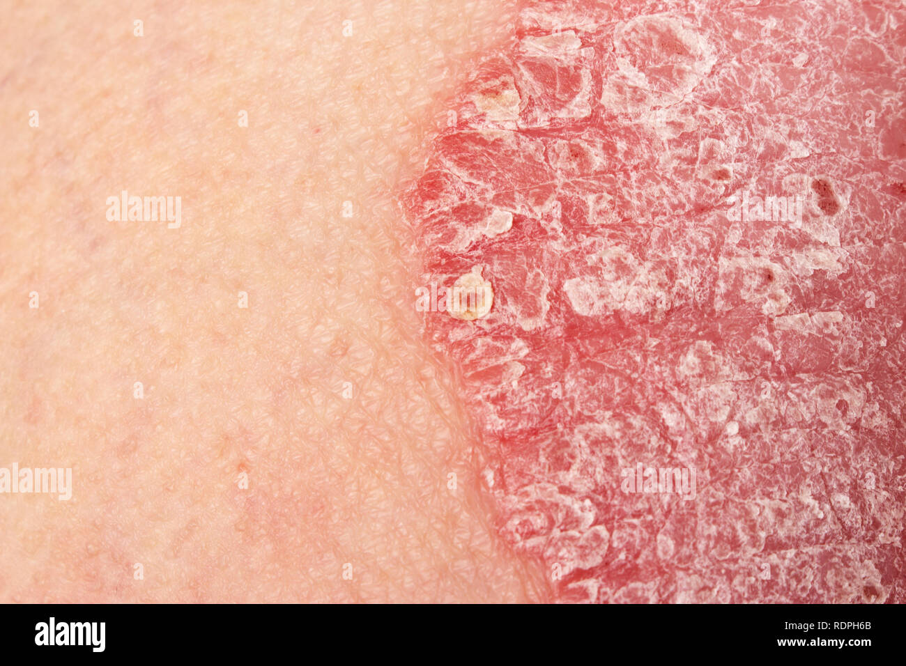 Psoriasis Vulgaris Stockfotos und -bilder Kaufen - Alamy