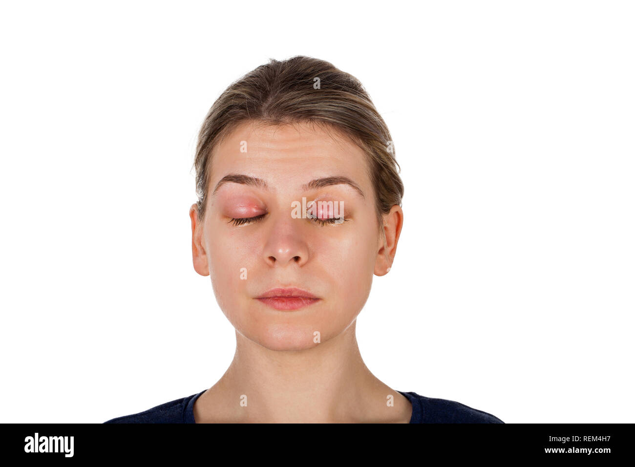 Eitrige konjunktivitis -Fotos und -Bildmaterial in hoher Auflösung – Alamy