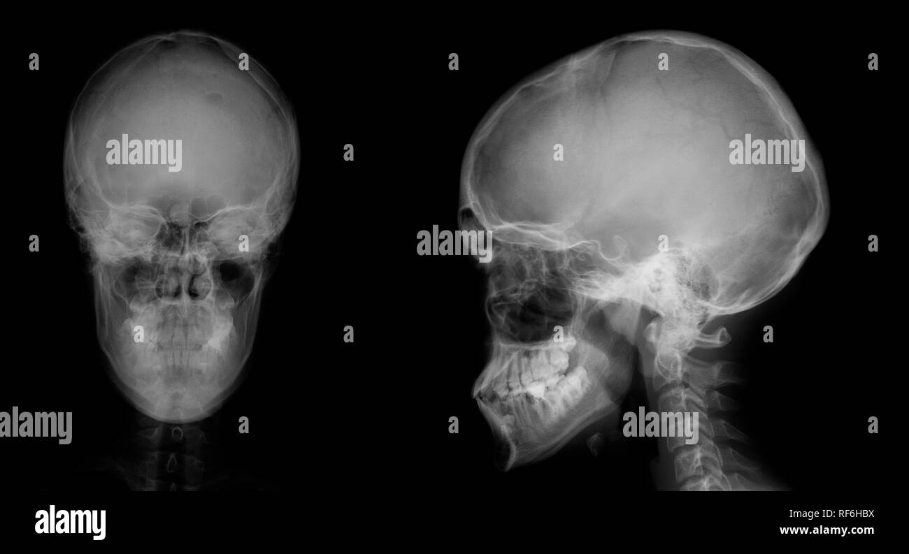 Osteoid Osteom Stockfotos und -bilder Kaufen - Alamy