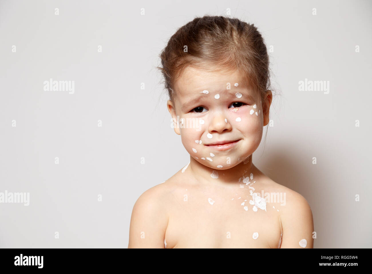 Closeup süße kleine Mädchen mit Varicella-zoster Virus oder Windpocken ...