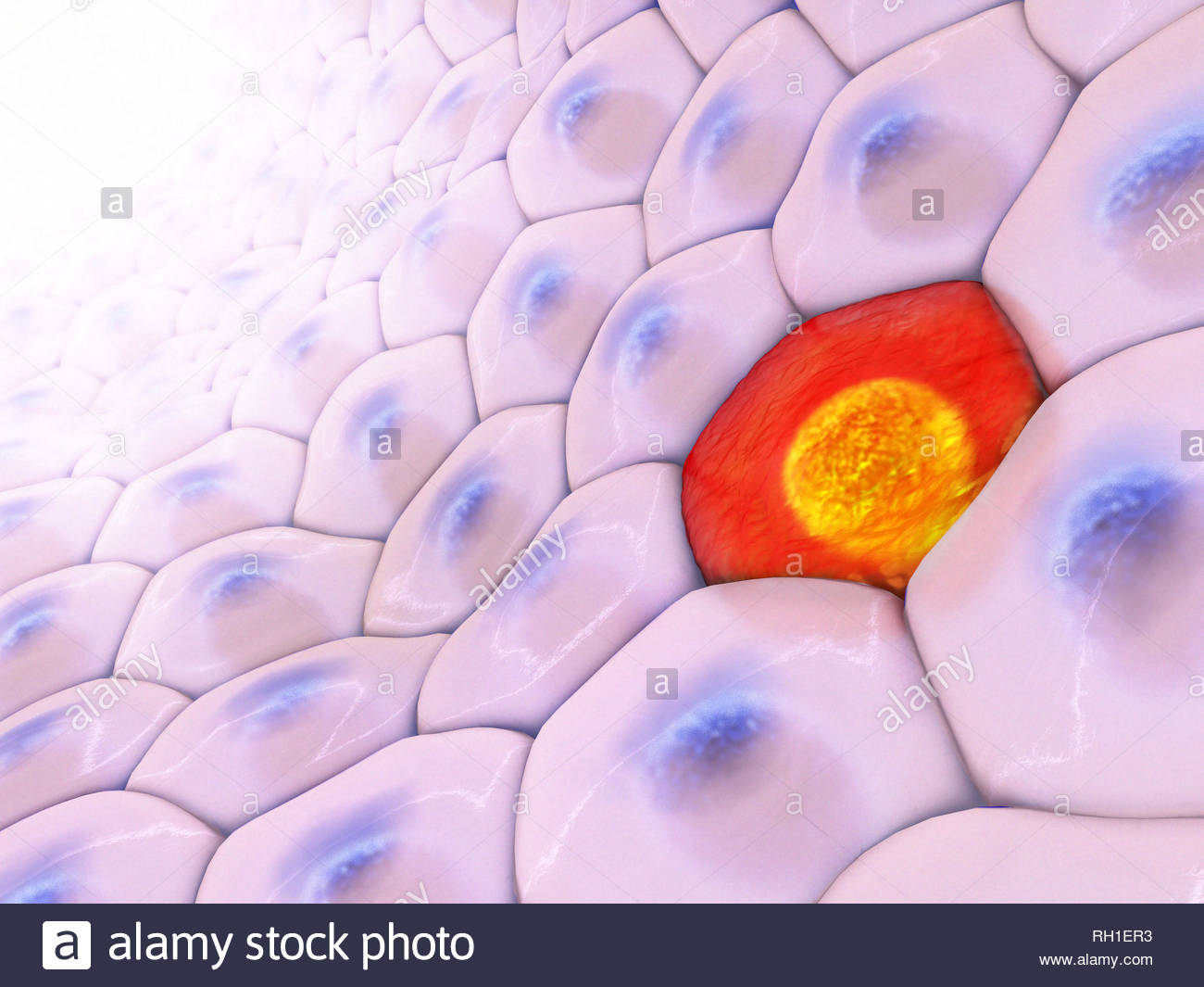 Tumor Der Haut Stockfotos & Tumor Der Haut Bilder - Alamy