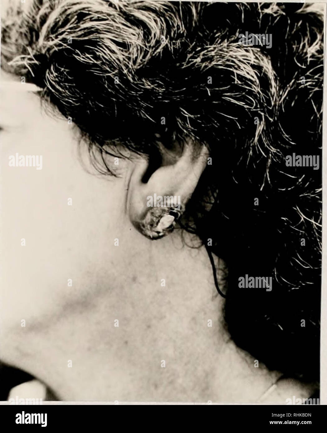 Leishmaniose mensch -Fotos und -Bildmaterial in hoher Auflösung – Alamy