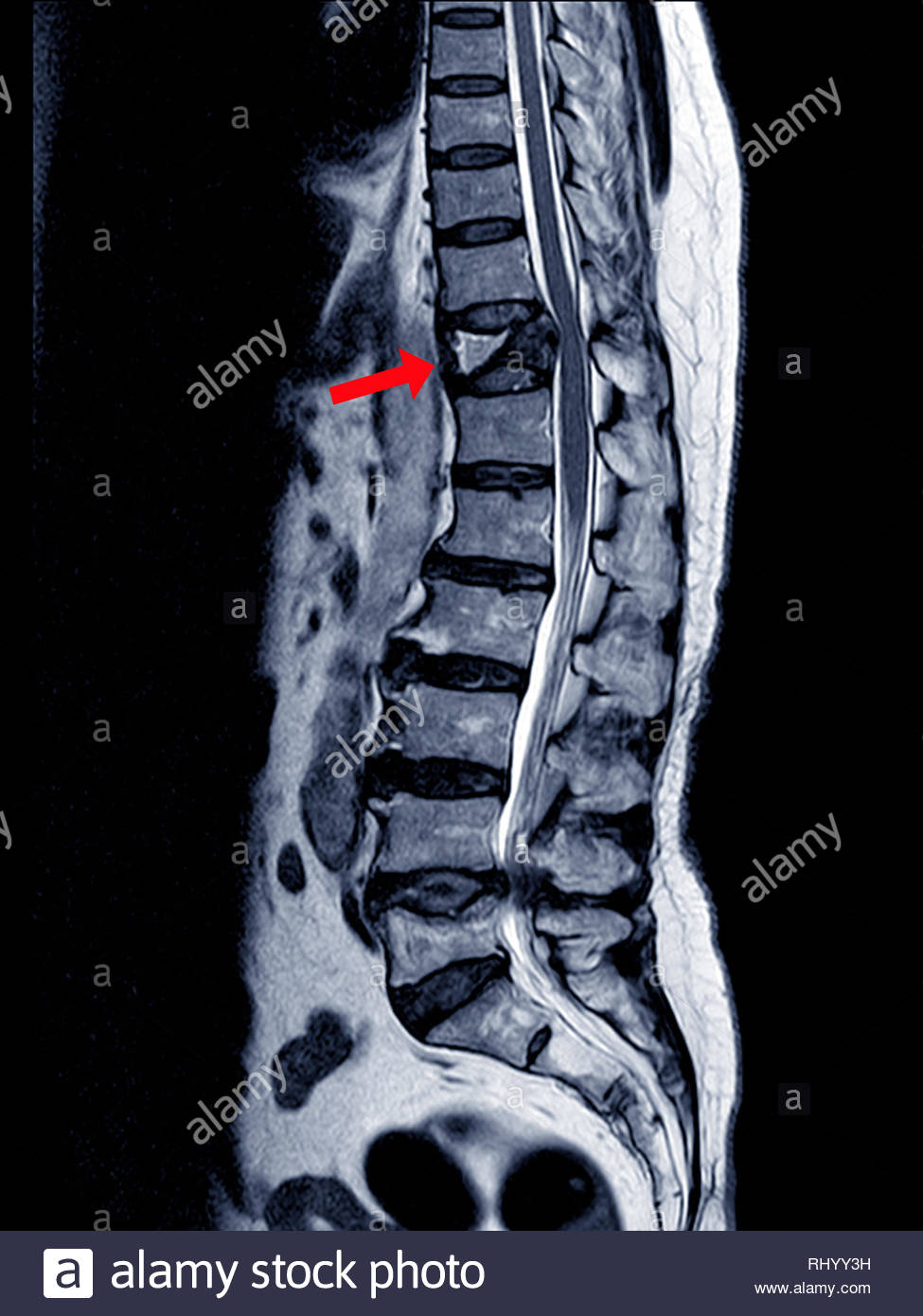 Cervical Disc Injury Stockfotos & Cervical Disc Injury Bilder - Alamy
