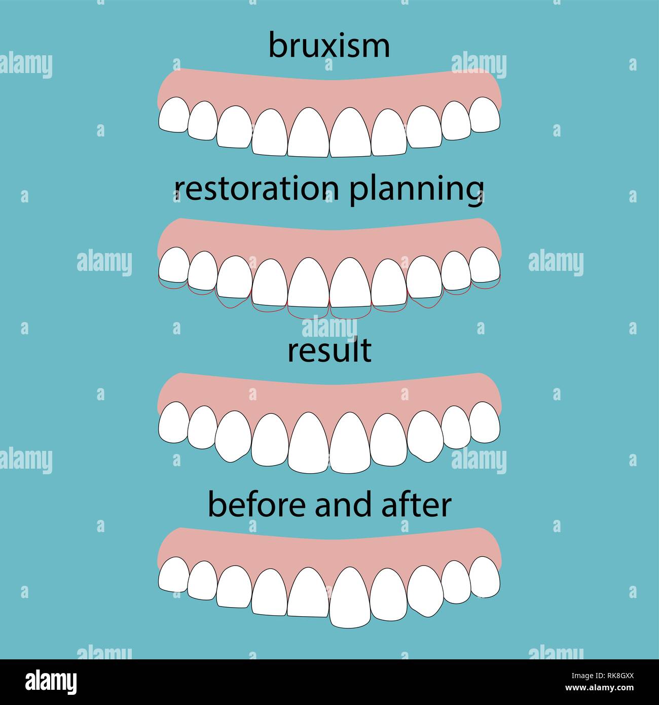 Layout attrition Bruxismus Zähne illustration Vektor. Gelöscht Zähne ...