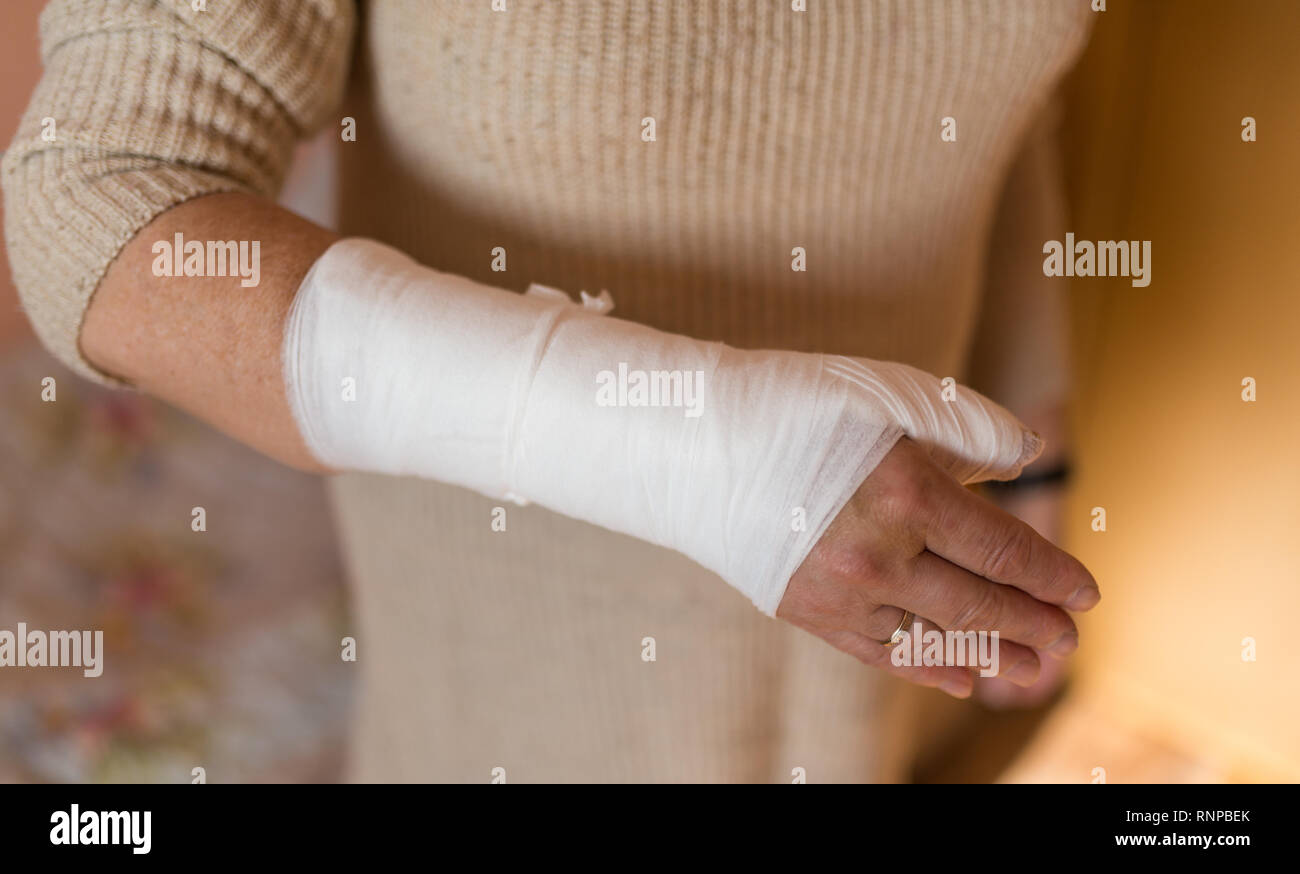 Gips in der hand -Fotos und -Bildmaterial in hoher Auflösung – Alamy
