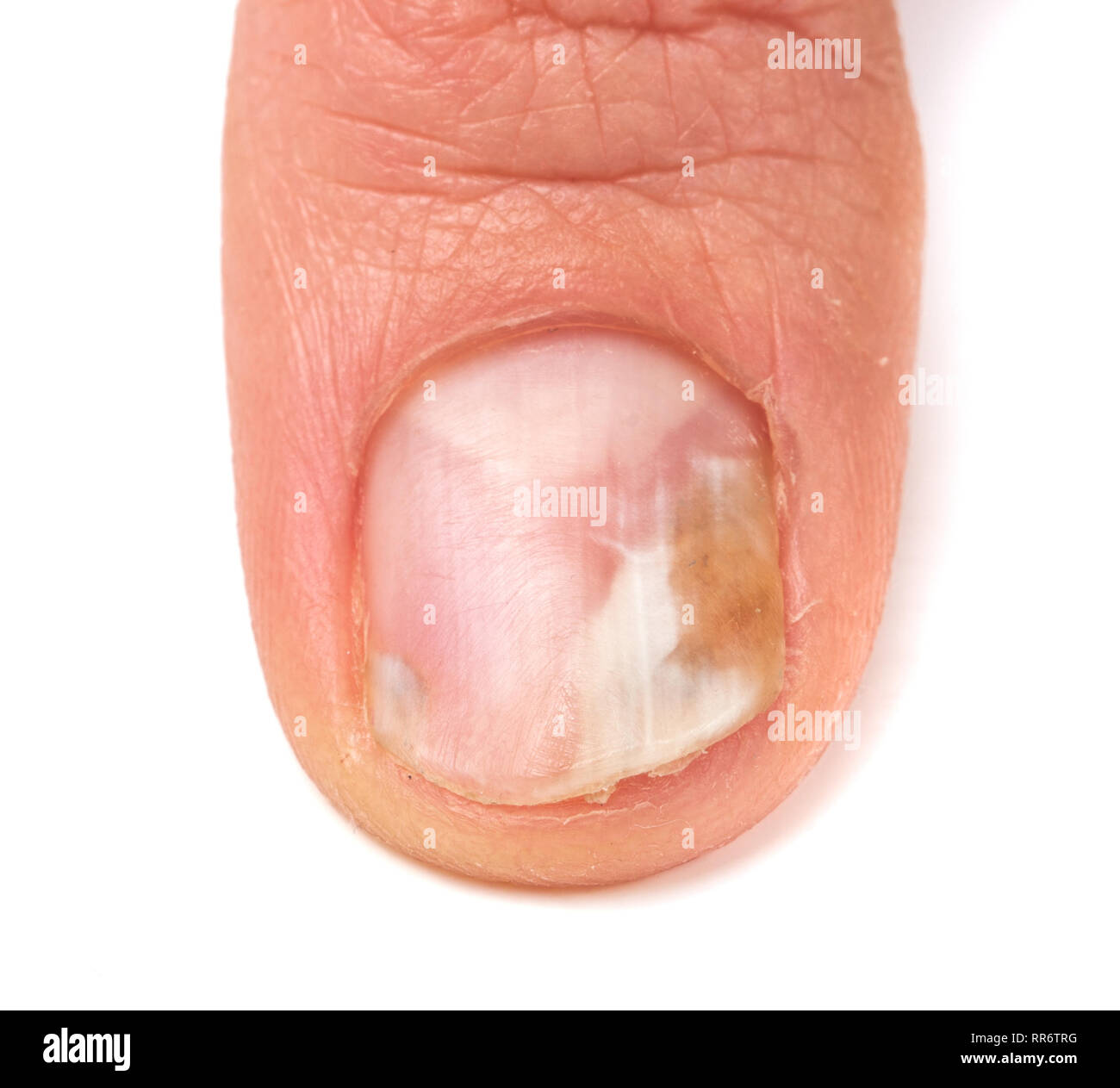 Fungal infection -Fotos und -Bildmaterial in hoher Auflösung – Alamy