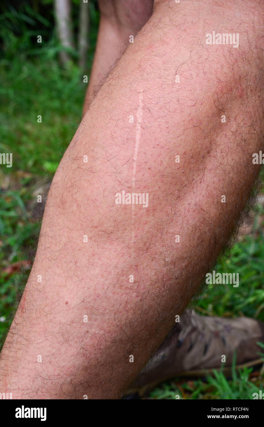 Narbe auf der haut -Fotos und -Bildmaterial in hoher Auflösung – Alamy