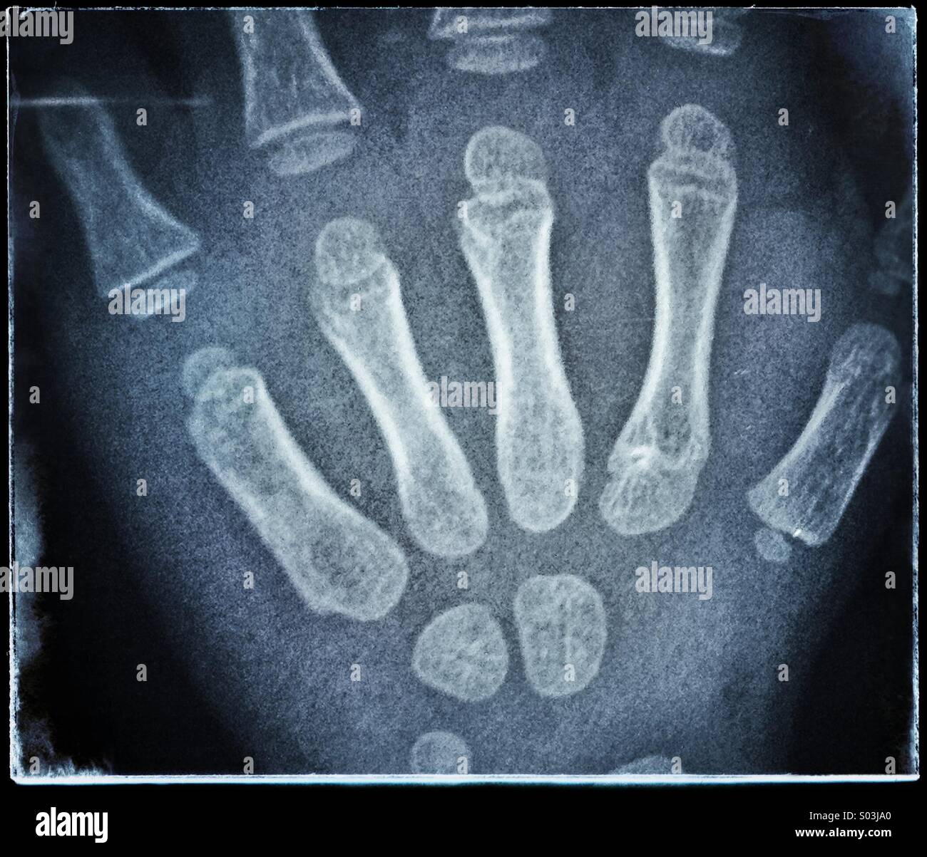Child hand x ray -Fotos und -Bildmaterial in hoher Auflösung – Alamy