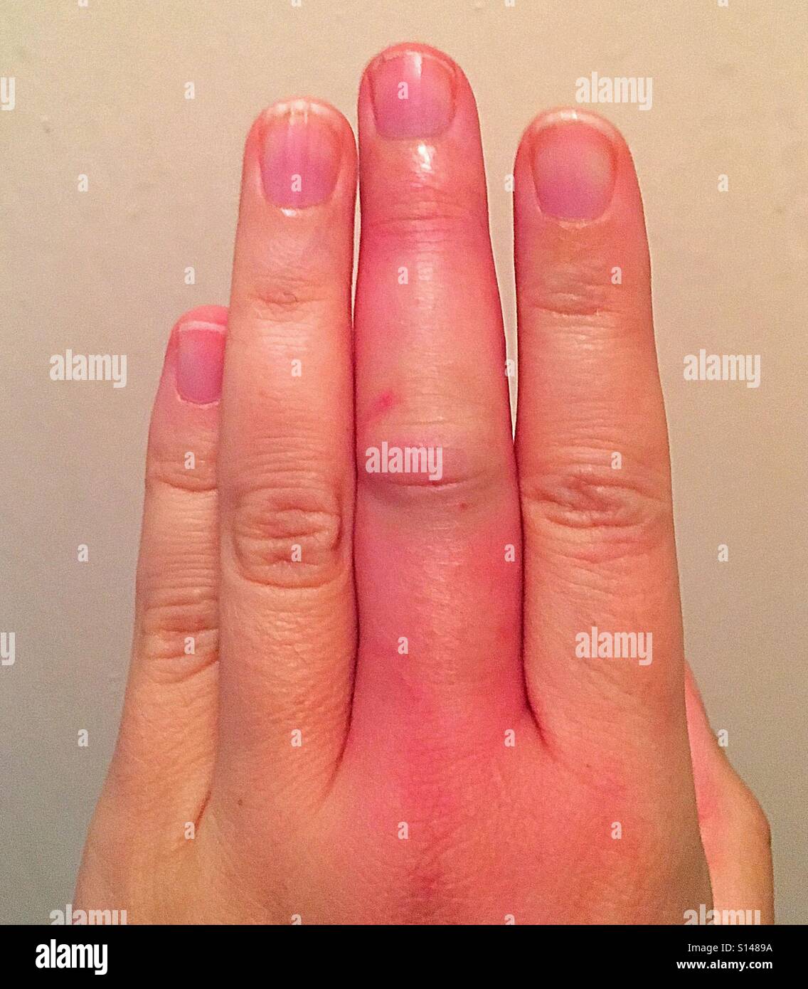 Swollen Infected Finger From Insect Fotos Und Bildmaterial In Hoher