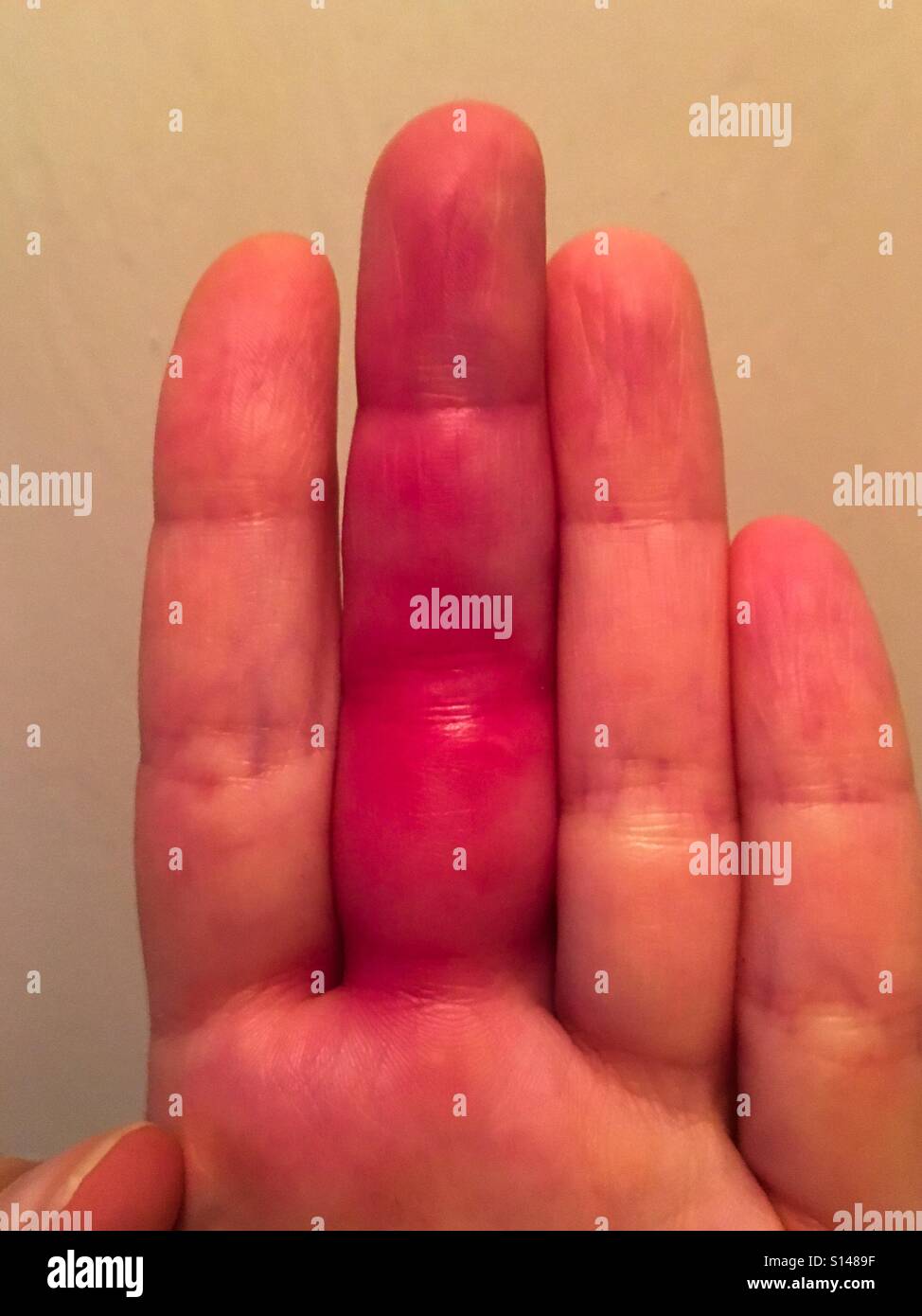 Swollen infected finger from insect -Fotos und -Bildmaterial in hoher ...