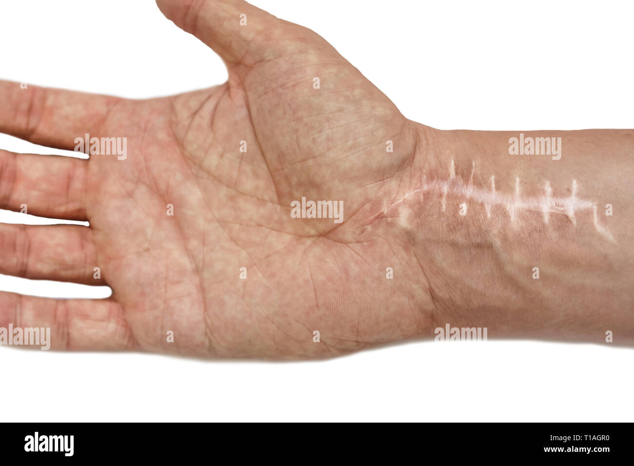 Narbe mit Stichen am Handgelenk nach der Operation. Bruch der Knochen ...