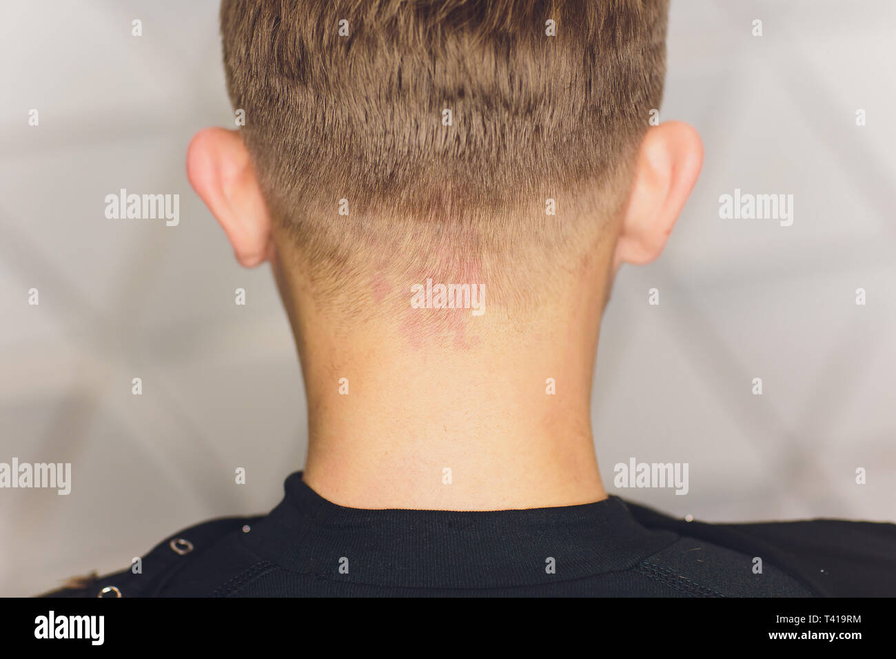 Noduläres melanom -Fotos und -Bildmaterial in hoher Auflösung – Alamy