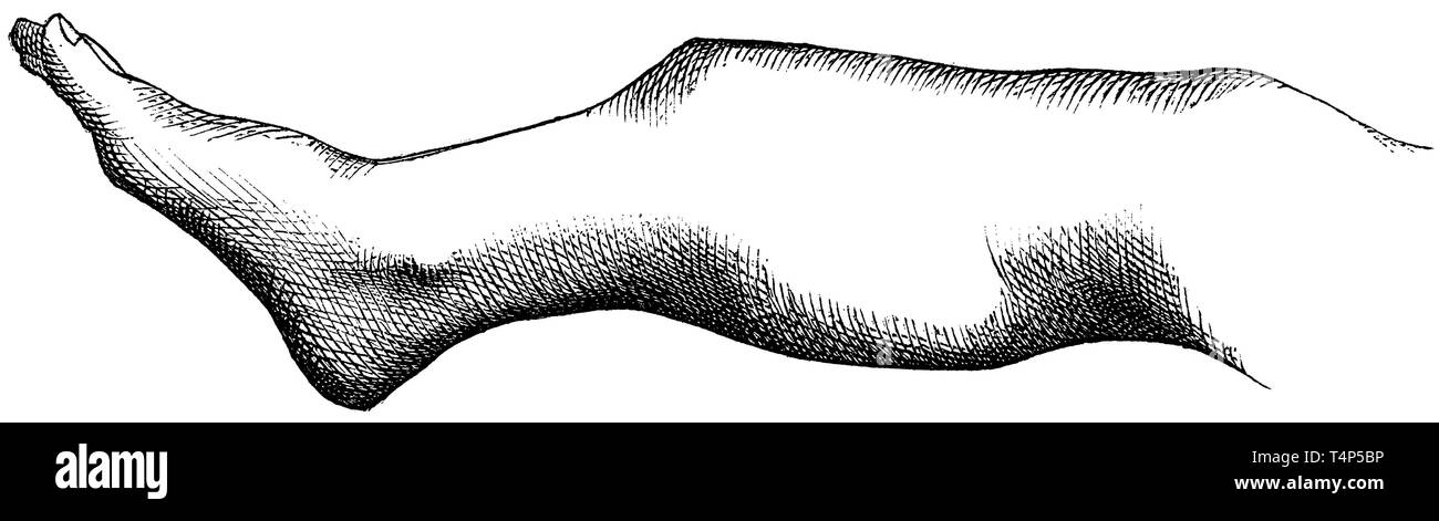 Knochenbruch historisch -Fotos und -Bildmaterial in hoher Auflösung – Alamy