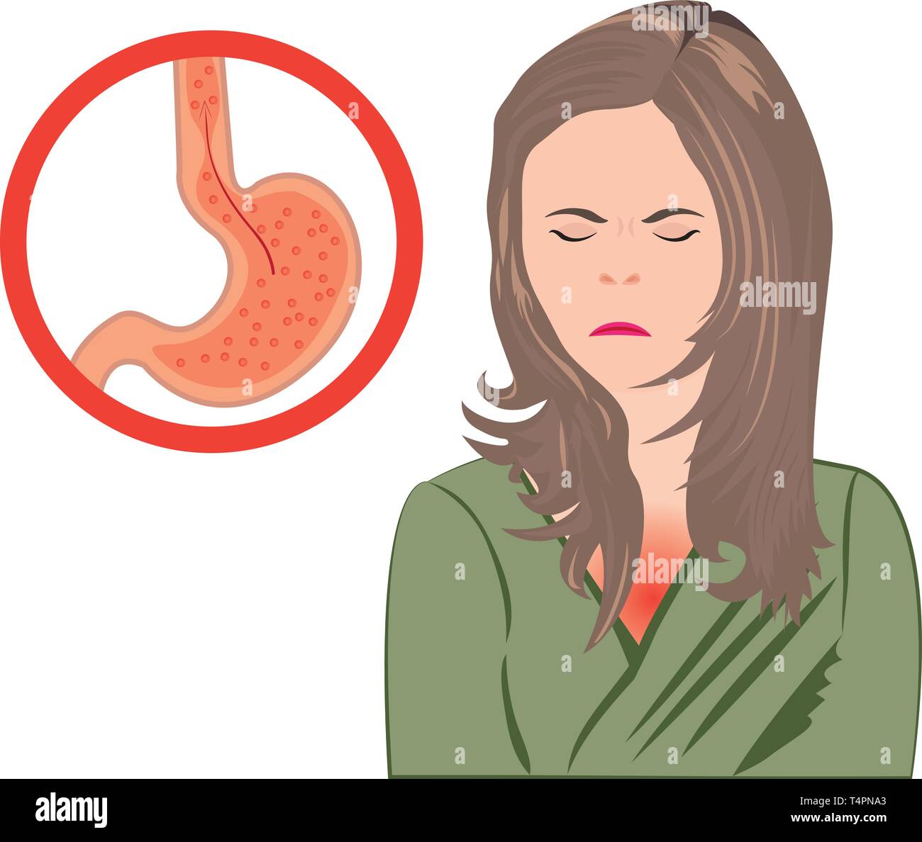 Gastroösophagealer Reflux Krankheit. Gerd Magen in einem menschlichen ...