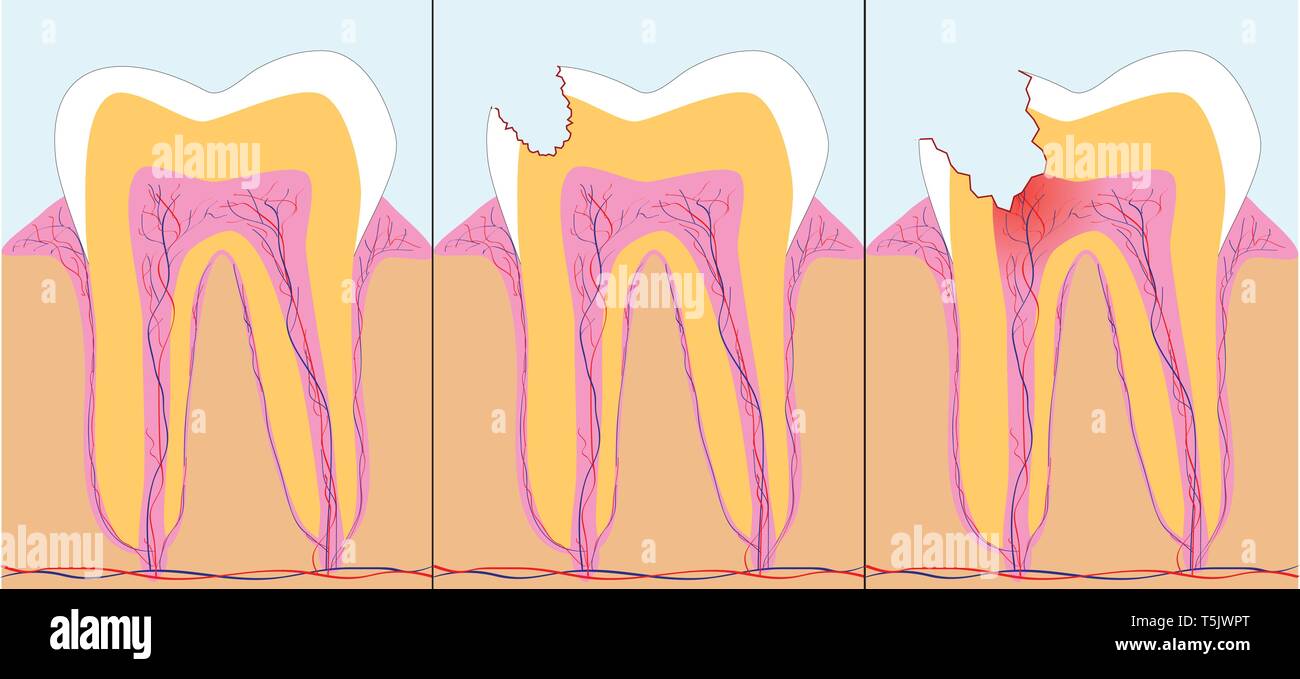 Drei Phasen der Karies, Vector Illustration Stock-Vektorgrafik - Alamy
