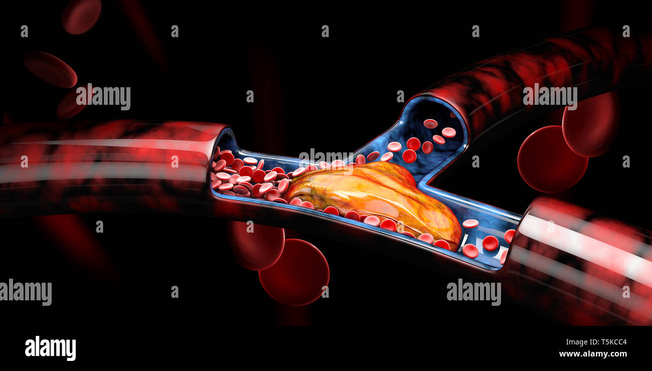 3D-Darstellung der tiefen Venenthrombose, Lungenembolie oder ...