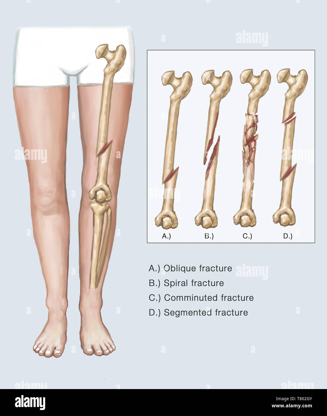 Gebrochenes bein -Fotos und -Bildmaterial in hoher Auflösung – Alamy