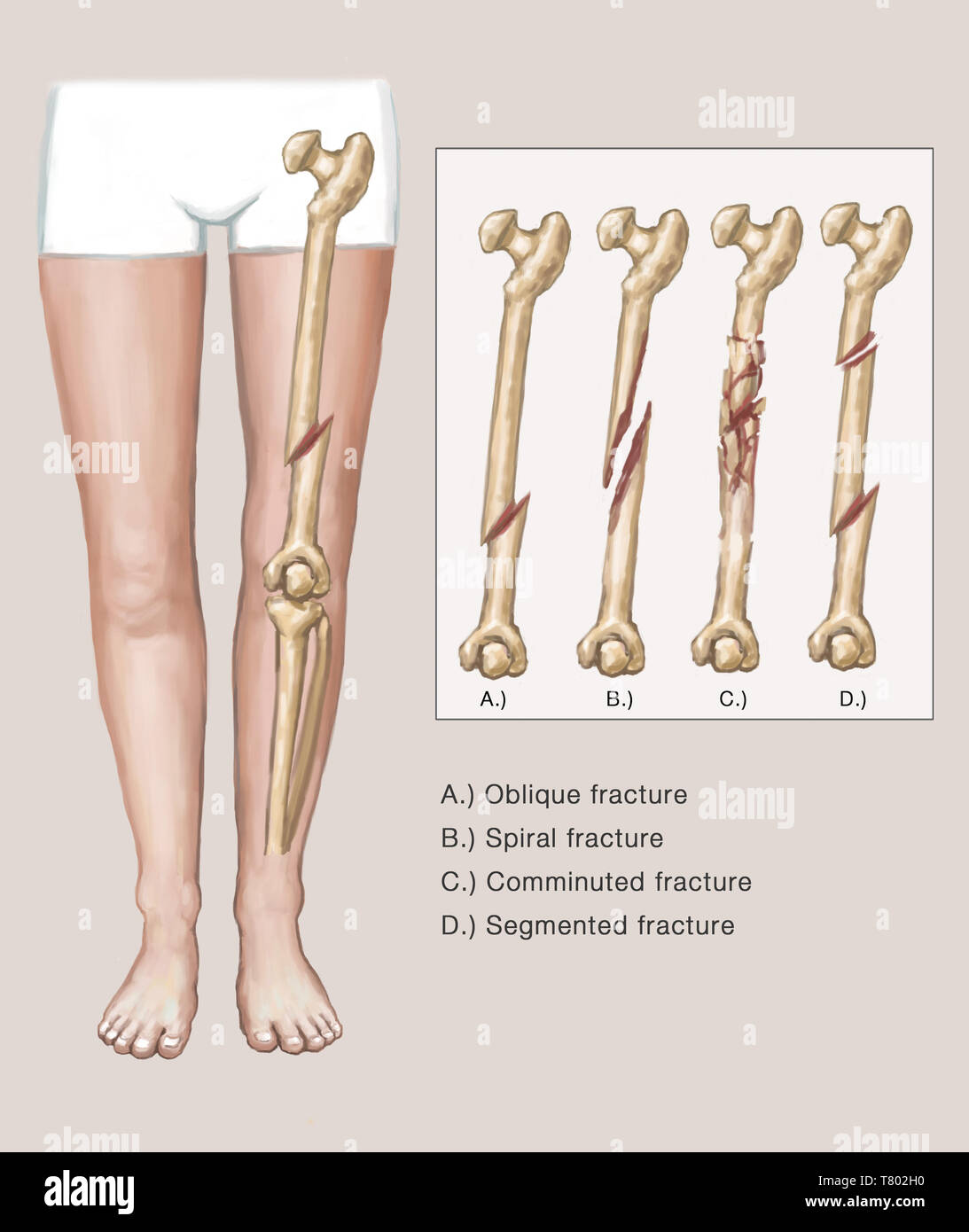 Comminuted fracture -Fotos und -Bildmaterial in hoher Auflösung – Alamy