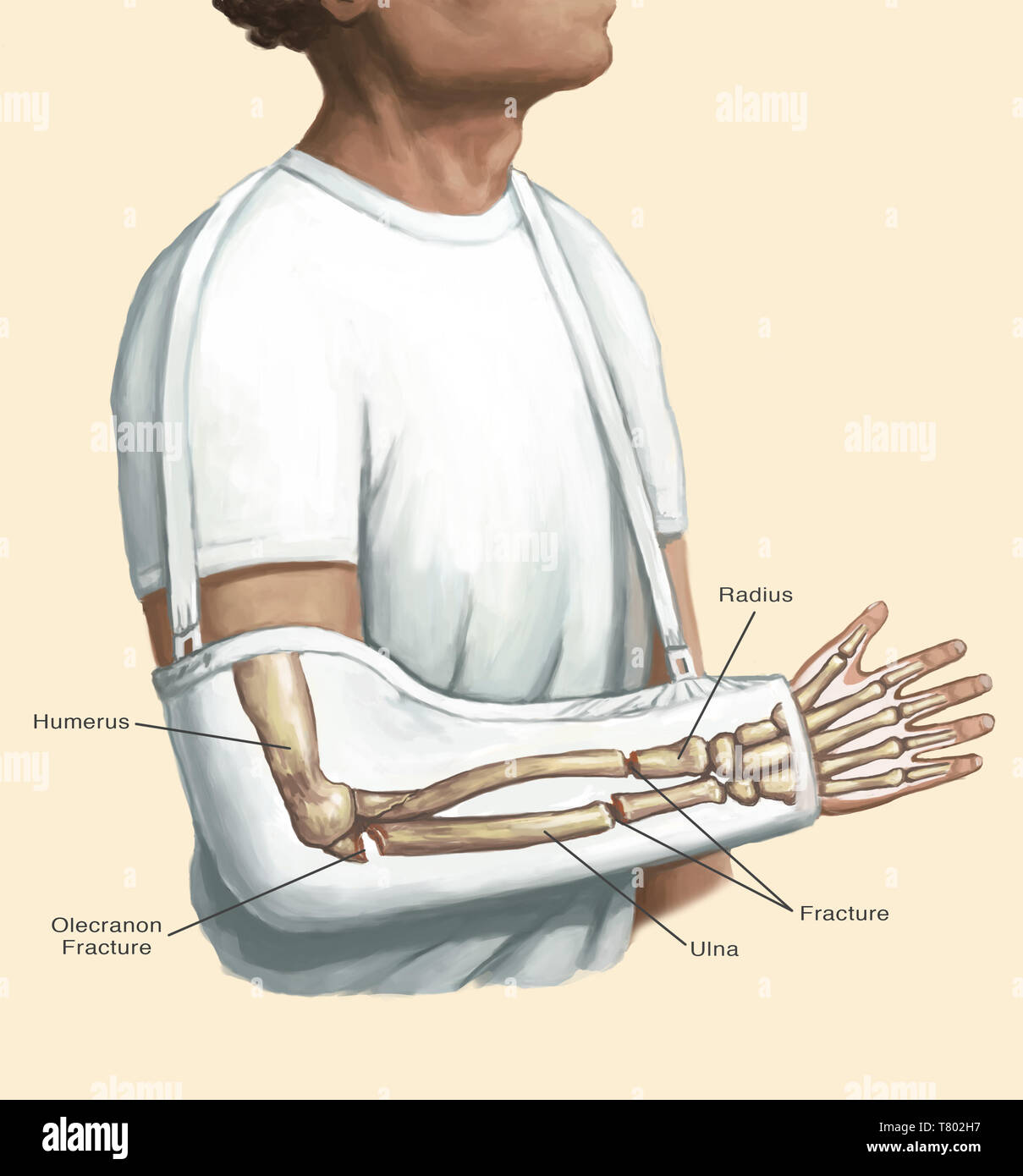 Fracture of radius -Fotos und -Bildmaterial in hoher Auflösung – Alamy