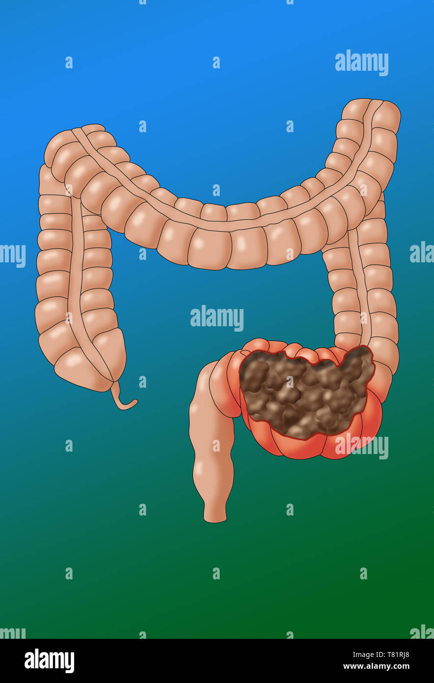 Verstopfung Darm, Abbildung Stockfotografie - Alamy