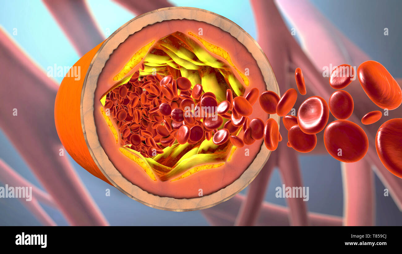 Arterielle thrombose -Fotos und -Bildmaterial in hoher Auflösung – Alamy