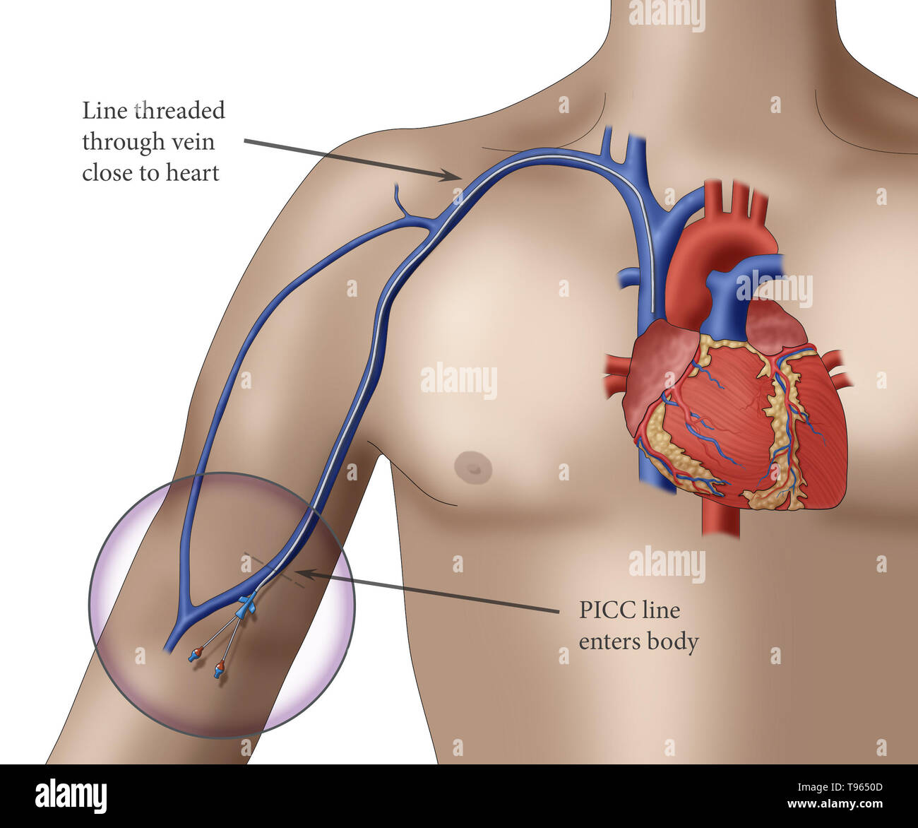 Abbildung: Darstellung einer PICC (peripher zentralen Katheter eingeführt), eine Form der ...