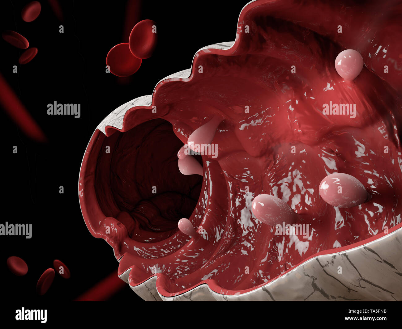 Darm polyp -Fotos und -Bildmaterial in hoher Auflösung – Alamy