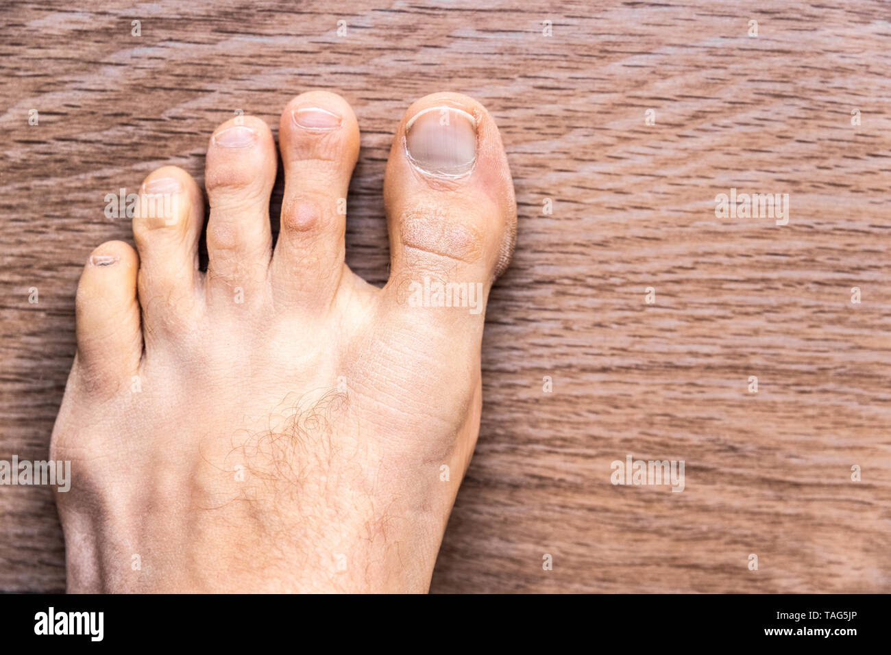 Psoriasis plaques -Fotos und -Bildmaterial in hoher Auflösung – Alamy
