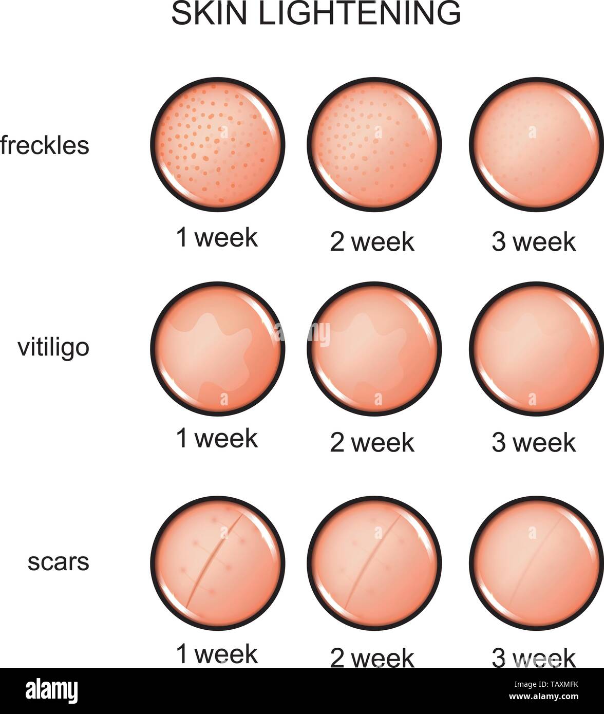 Vector Illustration der Aufhellung der Haut. Sommersprossen, Vitiligo ...