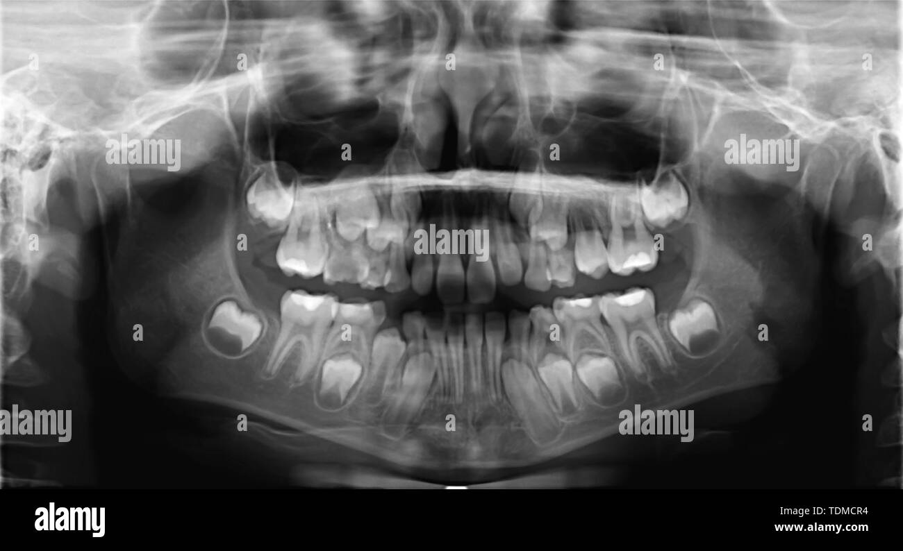 Röntgenbild kind kopf -Fotos und -Bildmaterial in hoher Auflösung – Alamy