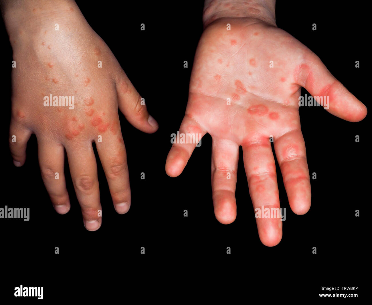 Skin rash eczema on hands -Fotos und -Bildmaterial in hoher Auflösung ...