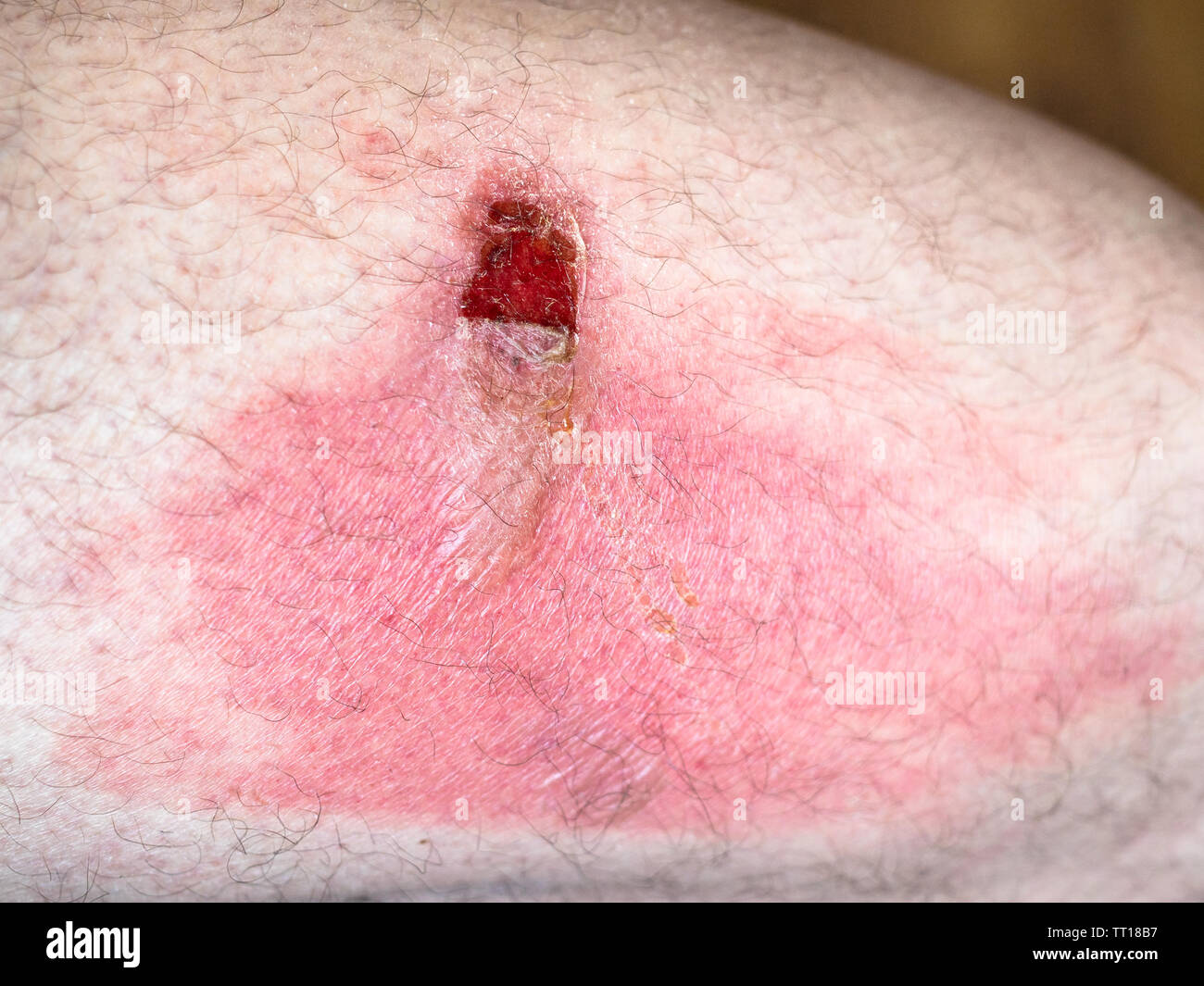 Offene beinwunde behandlung -Fotos und -Bildmaterial in hoher Auflösung ...